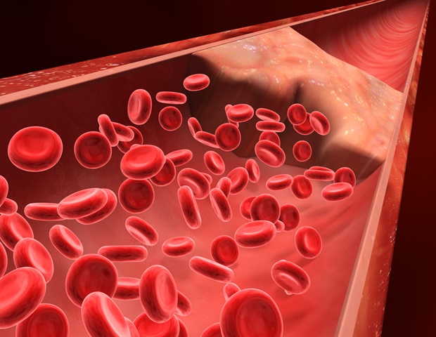 COVID-19 makes platelets 'hyperactive' and more prone to form deadly ...