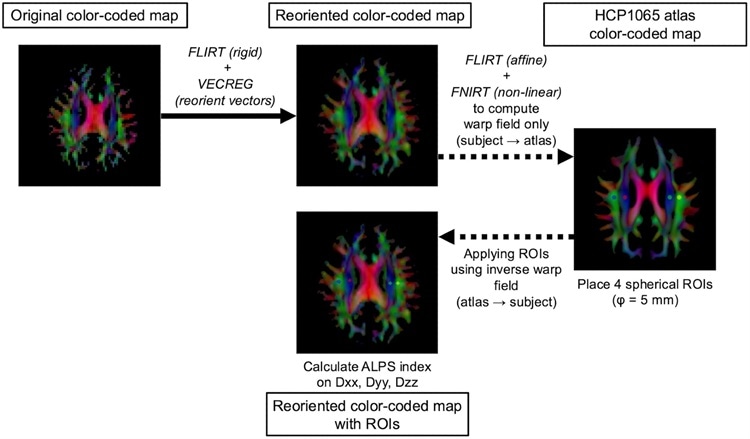 No Early Improvement in Brain Waste Clearance with Lecanemab