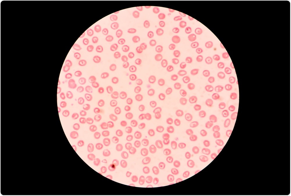 Small Red Blood Cells Could Indicate Cancer